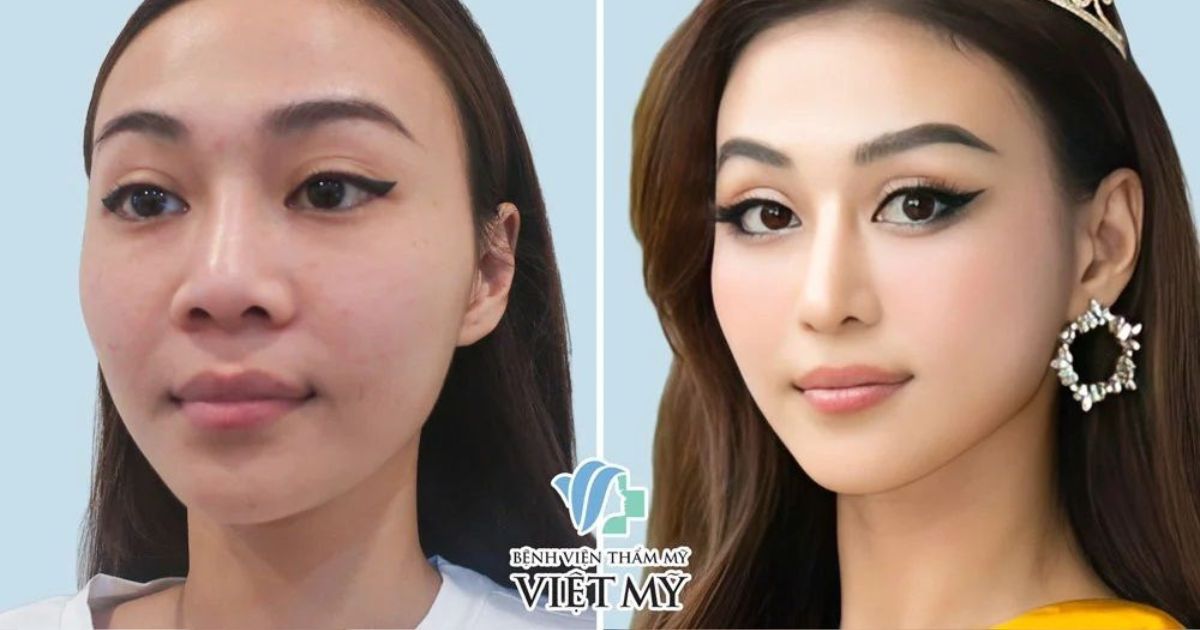 Nâng mũi cấu trúc có được lâu dài không? Nâng mũi ở đâu đẹp?